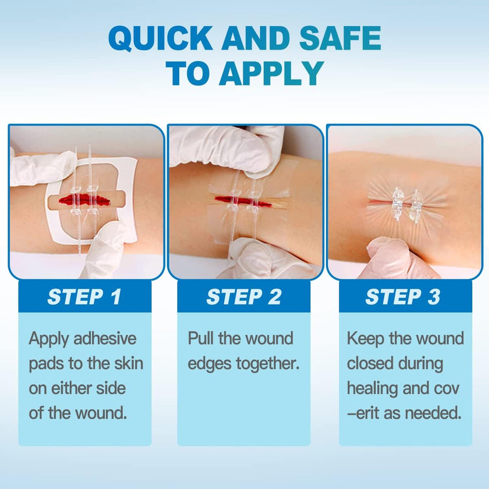 SENVOK - Advanced Wound Closure with Interlaced Locking Technology ...